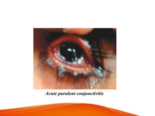 CONJUNCTIVITIS .pptx inflammation of the conjunctiva and types | PPTX