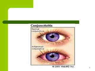conjunctivitis etiopathogenesis and clinical manifestations | PPT