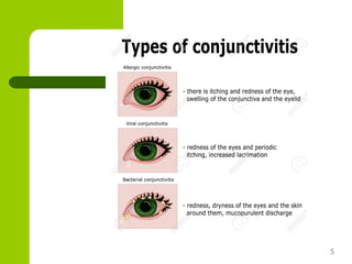 conjunctivitis etiopathogenesis and clinical manifestations | PPT