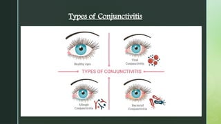 Conjunctivitis types and their managemant.pptx