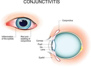 CONJUNCTIVITIS.definition,causes,types,management | PPTX