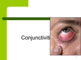 conjunctivitis.pathogenesis and etiology | PPT