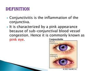Conjunctivitis | PDF