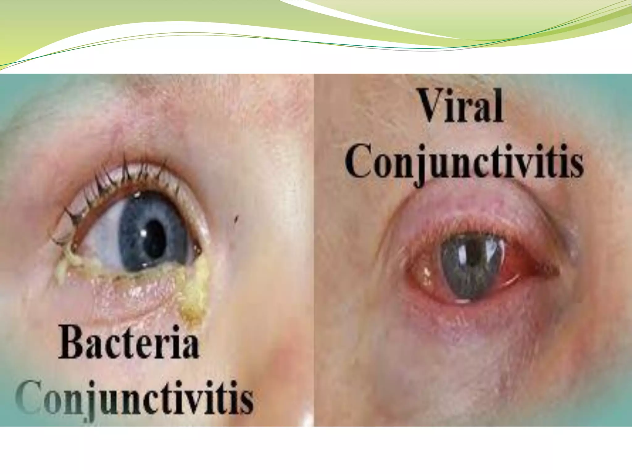 Conjunctivitis | PDF