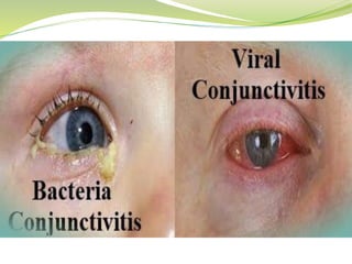 Bacterial Vs Viral Conjunctivitis
