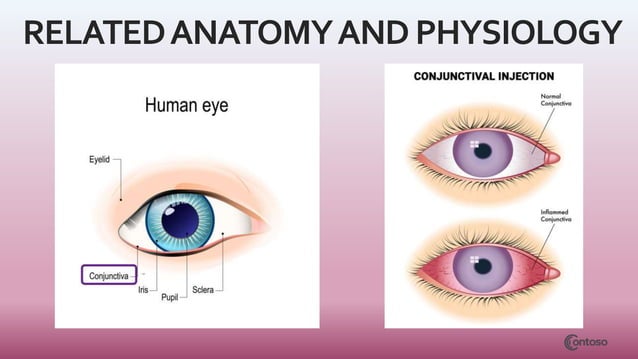 Conjunctivitis - its types, clinical manifestation and nursing ...