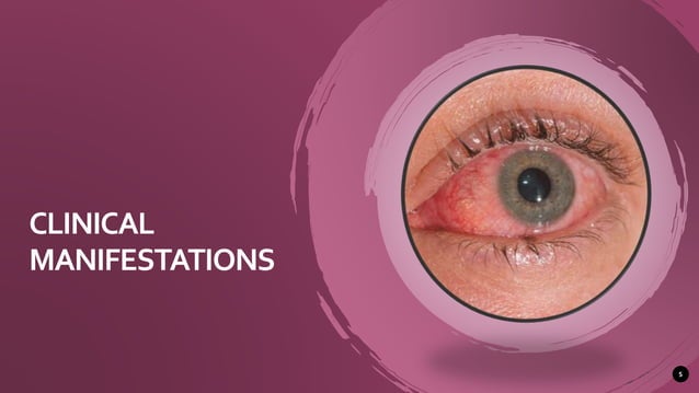 Conjunctivitis - its types, clinical manifestation and nursing ...