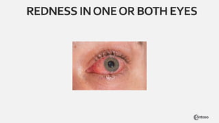 Conjunctivitis - its types, clinical manifestation and nursing ...