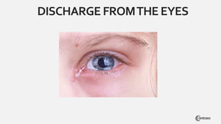 Conjunctivitis - its types, clinical manifestation and nursing ...