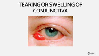 Conjunctivitis - its types, clinical manifestation and nursing ...