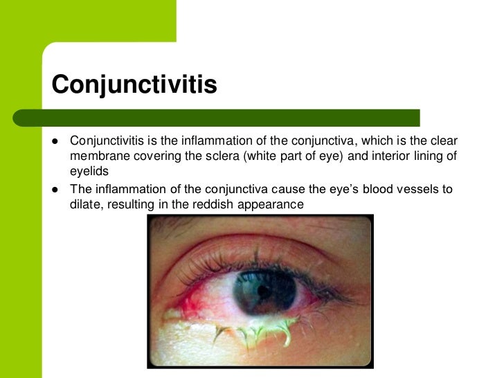 Conjunctivitis 1