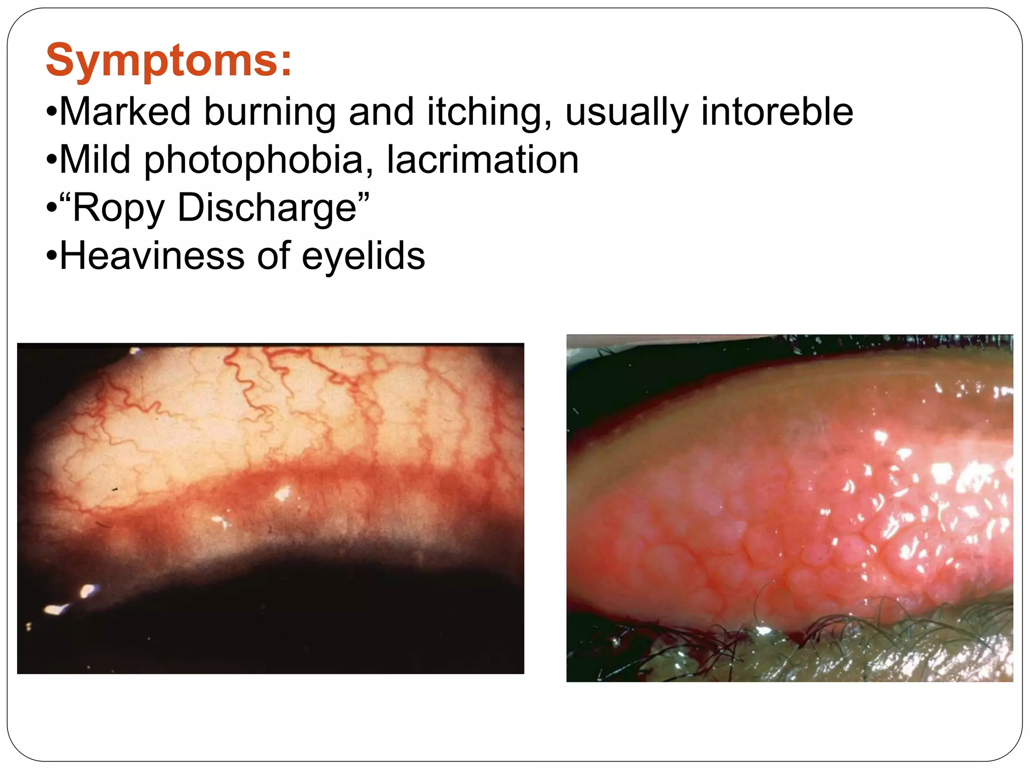 Conjunctivitis | PPTX