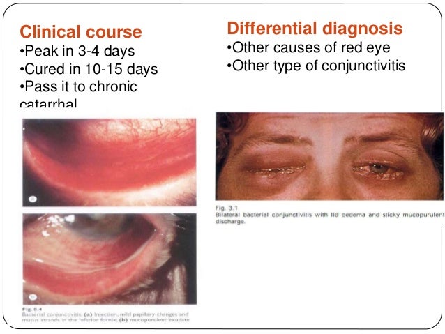 Conjunctivitis