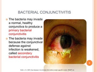 Conjunctivitis by Muhammad ibrahim | PPSX