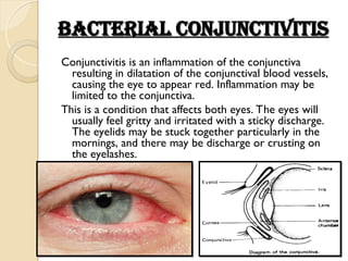 Eye infection & Conjunctivitis Medication.ppt
