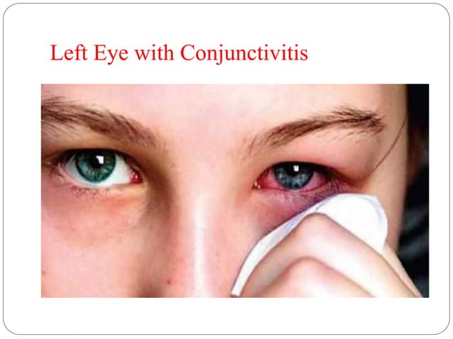 Conjunctivitis presentation (2).pptx