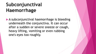 Conjunctivitis harun malik | PPTX