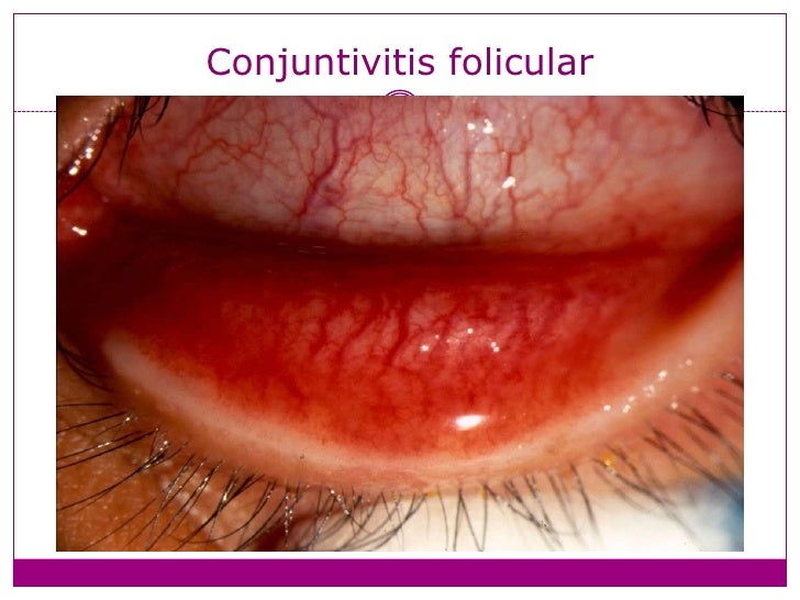 Conjuntiva
