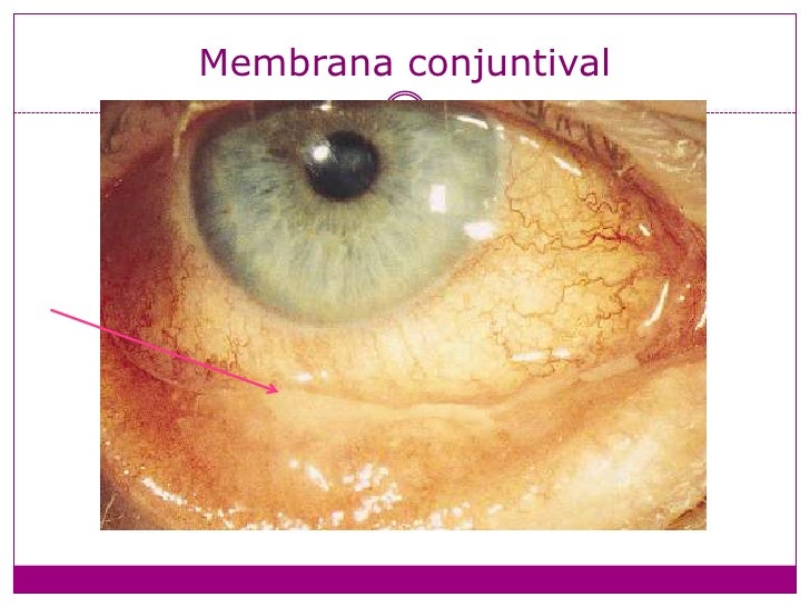 Conjuntiva