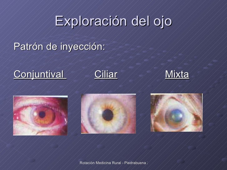 Conjuntivitis