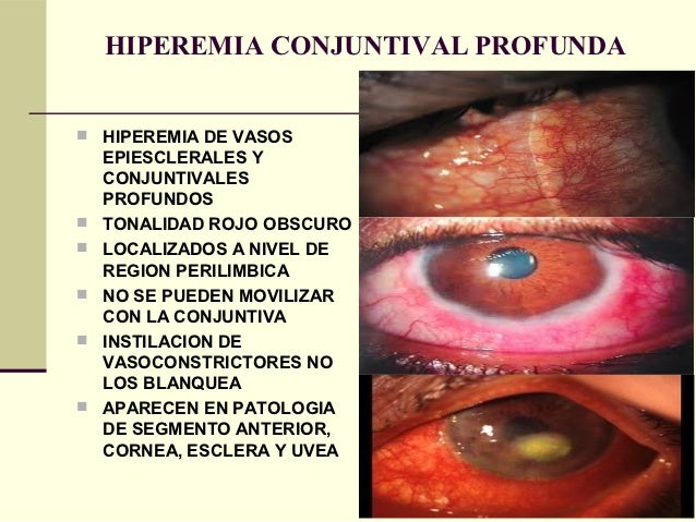 Conjuntivitis