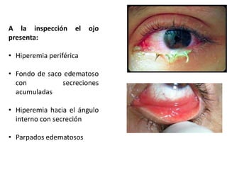 Conjuntivitis | PPTX