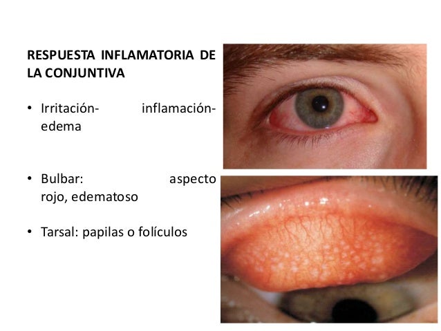 Conjuntivitis