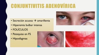 Conjuntivitis oftalmologia | PDF