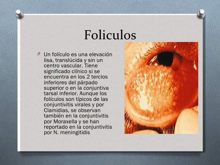 Conjuntivitis (1)