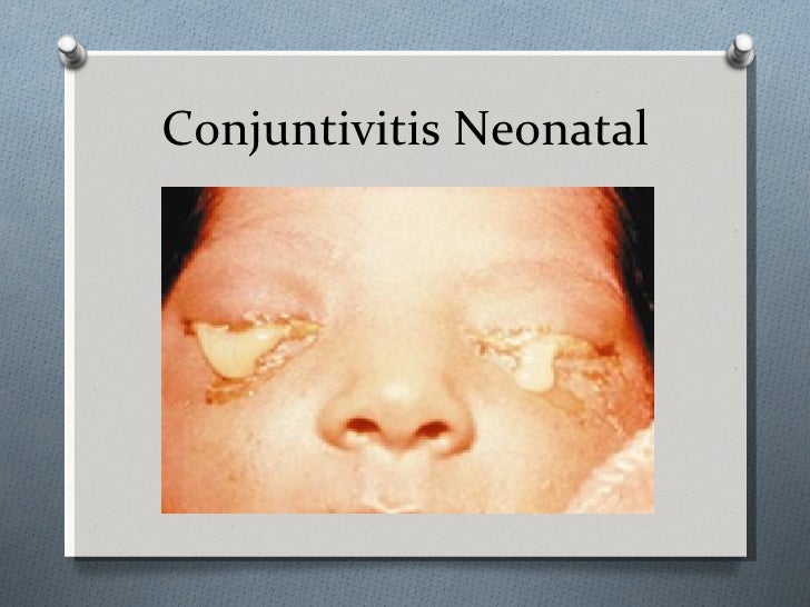 Conjuntivitis (1)