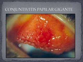 Conjuntivitis alergica | PPTX