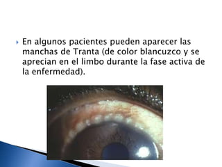 Conjuntivitis alérgica | PPTX