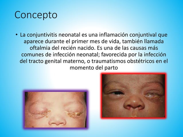 Conjuntivitis Neonatal