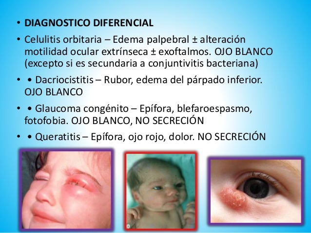 Conjuntivitis neonatal