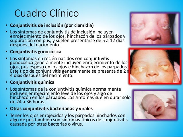 Conjuntivitis neonatal