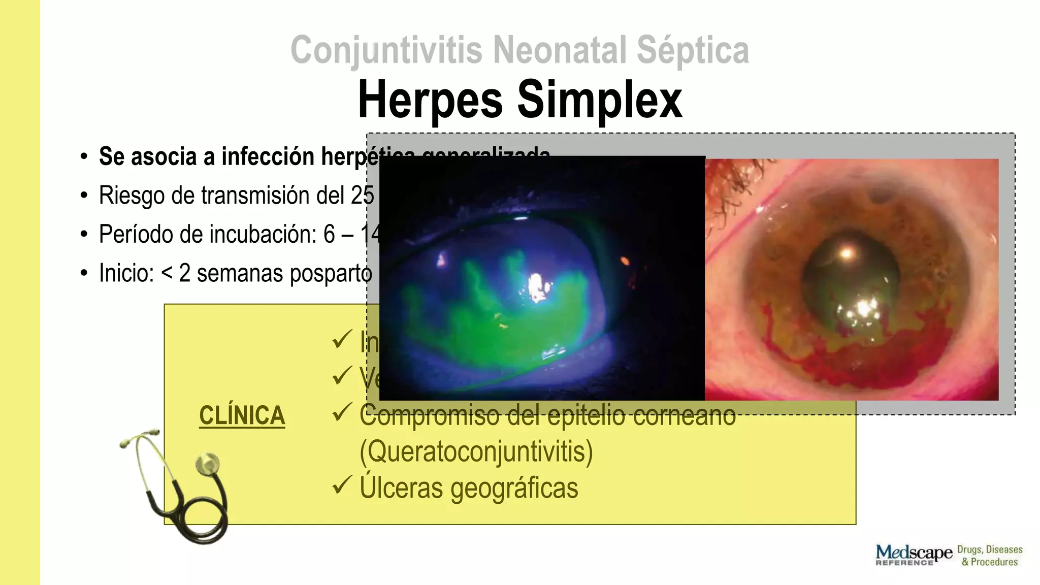 Conjuntivitis neonatal | PPTX