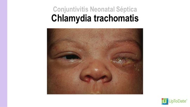 Conjuntivitis neonatal
