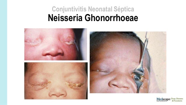 Conjuntivitis neonatal