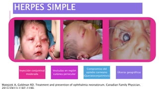CONJUNTIVITIS NEONATAL | PPTX