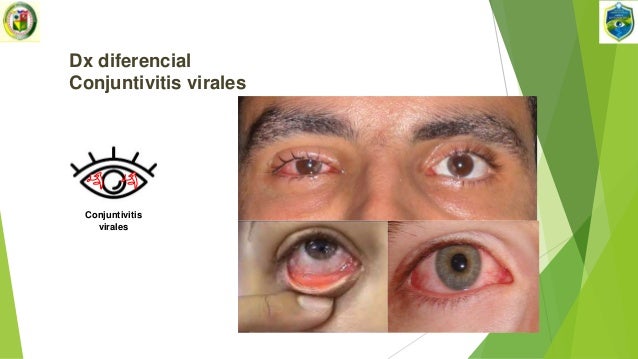 Conjuntivitis Virales