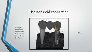 Implant splinting with natural tooth | PPTX | Dental Health | Diseases ...