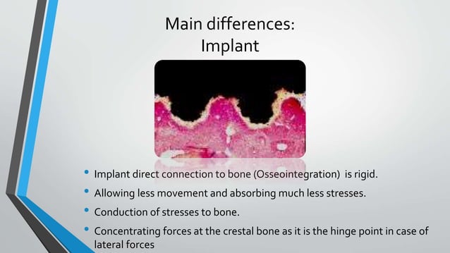 Implant splinting with natural tooth | PPT