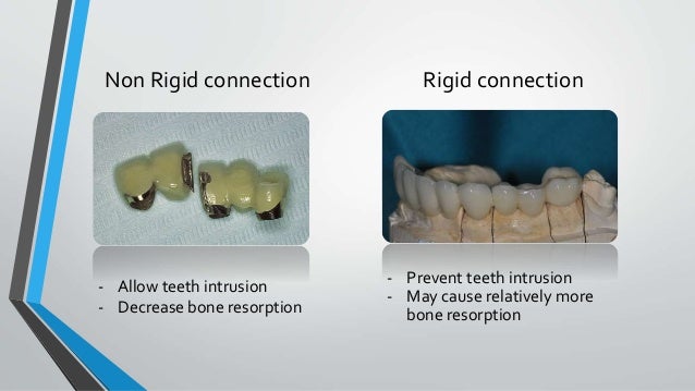 Implant splinting with natural tooth