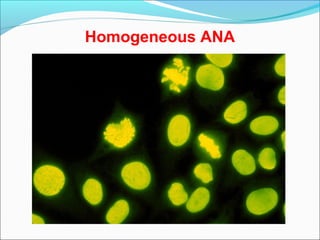 Connective tissue diseases (7) | PPT