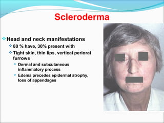 Connective tissue diseases (7) | PPT