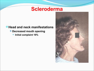 Connective tissue diseases (7) | PPT