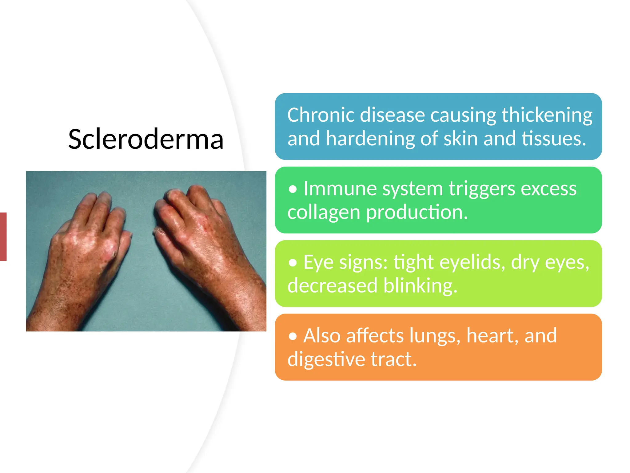 Connective_Tissue_Diseases_Preentation (1).pptx