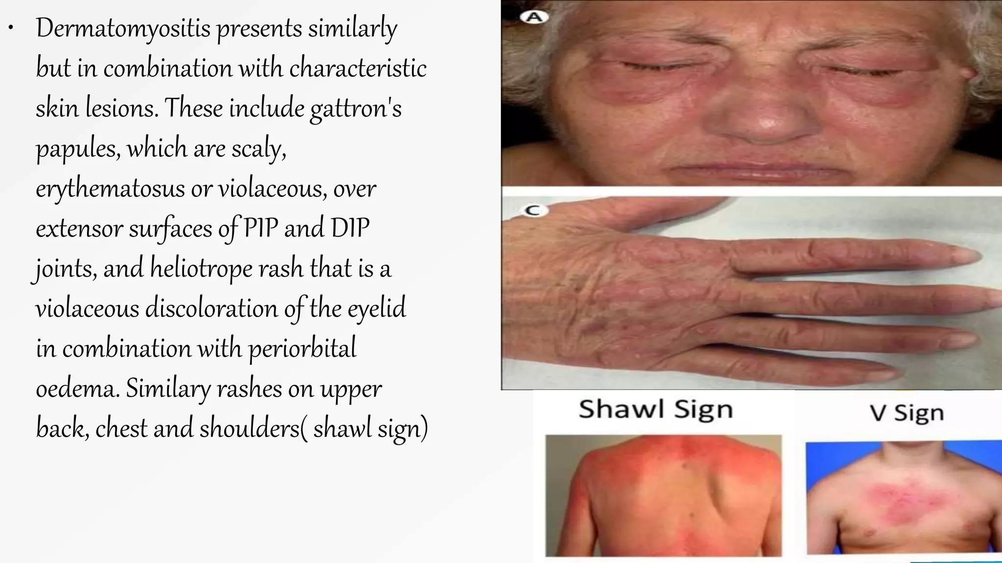 Connective tissue diseases | PPTX