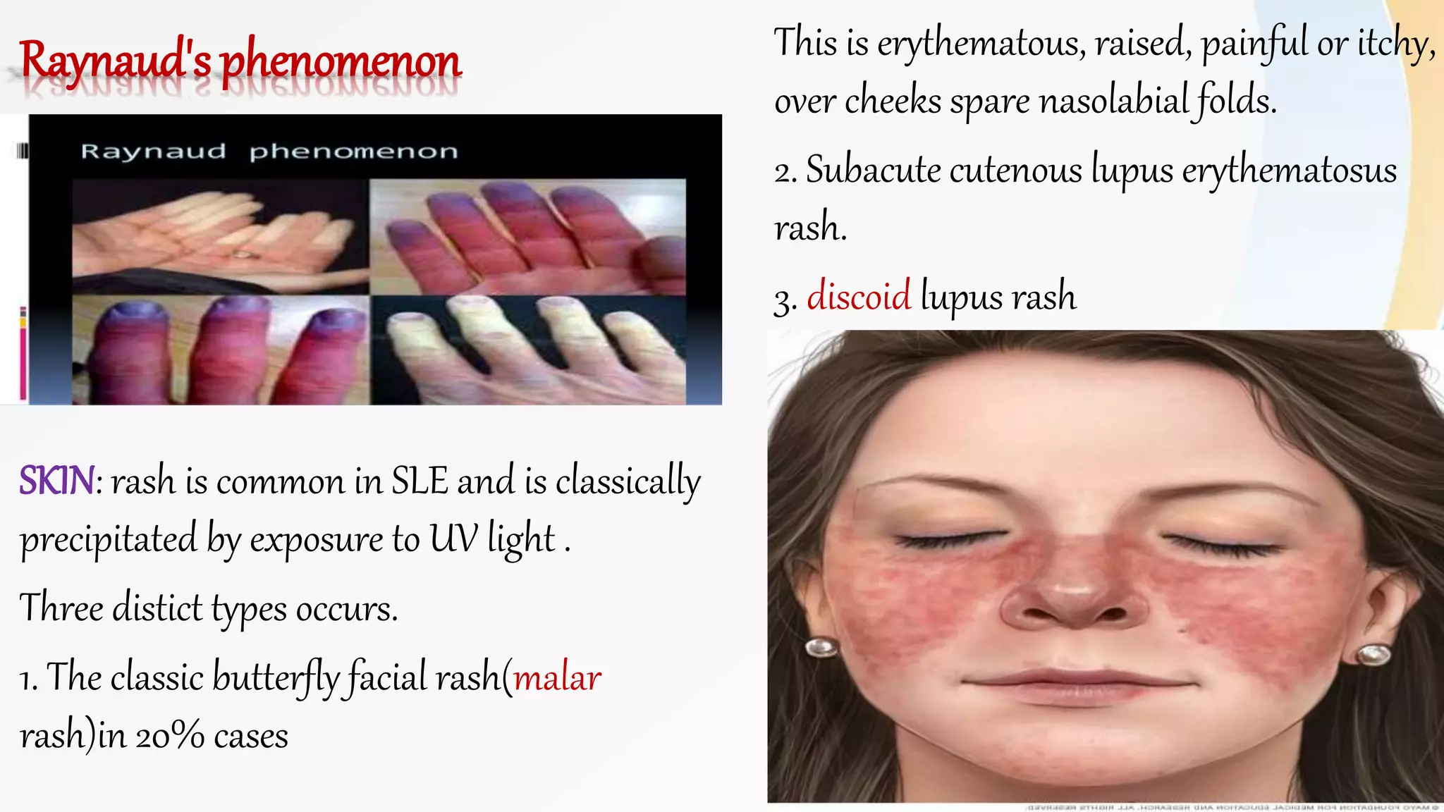 Connective tissue diseases | PPTX