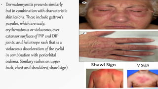 Connective tissue diseases | PPTX